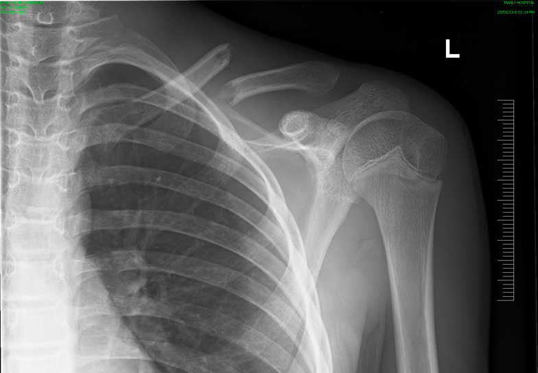 Clavicle Anatomy Xray